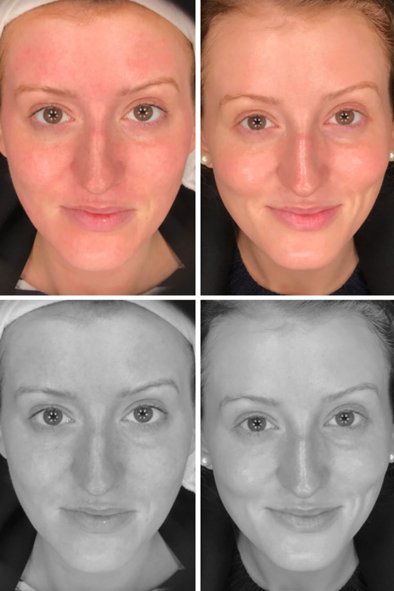 MY FRAXEL BEFORE AND AFTER | Design Darling